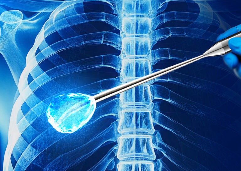 Cryosurgery – Minimally Invasive Treatment of Tissue Lesions – Metrum ...